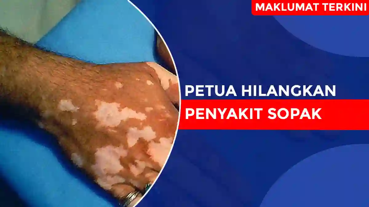 4 Petua Hilangkan Penyakit Sopak dan Punca - Infoubat.com