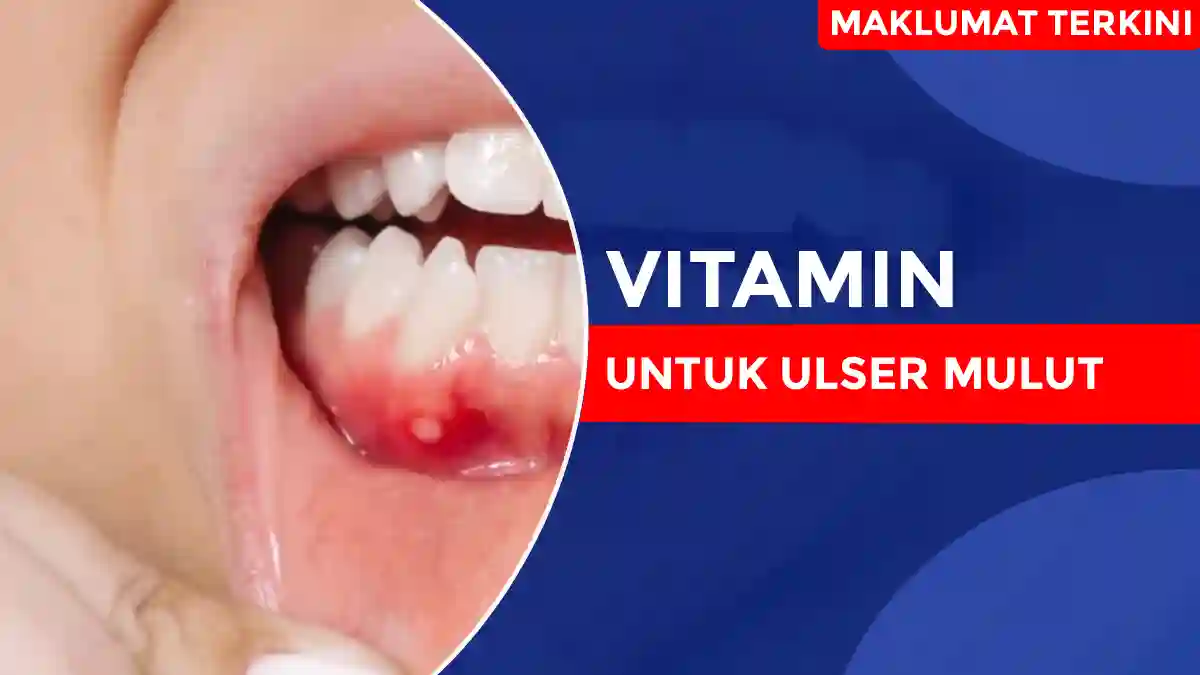 4 Vitamin Untuk Ulser Mulut Terbaik 2026 - Infoubat.com